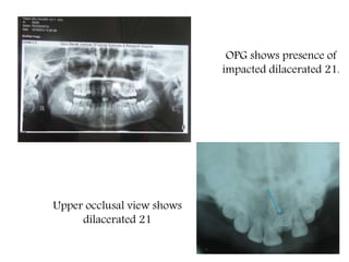 Surgical extraction dilacerated tooth | PPTX