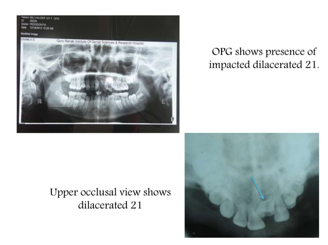 Surgical extraction dilacerated tooth | PPT