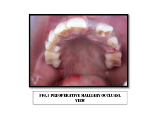 Surgical extraction of dilacerated tooth | PPTX