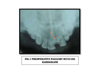 Surgical extraction of dilacerated tooth | PPTX