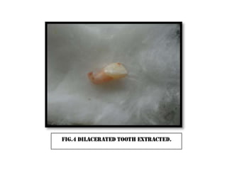 Surgical extraction of dilacerated tooth | PPTX