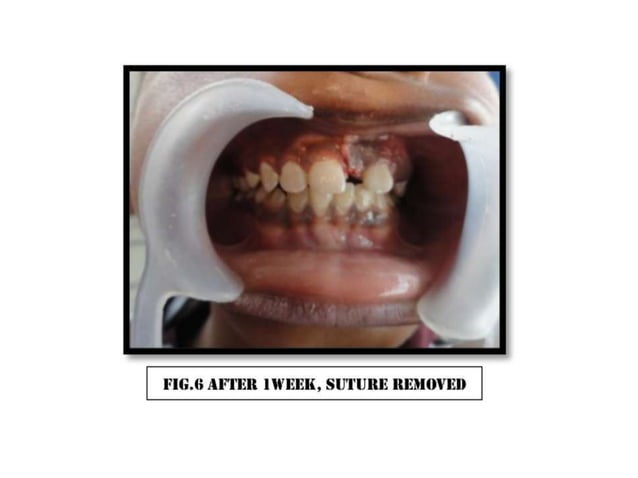 Surgical extraction of dilacerated tooth | PPT