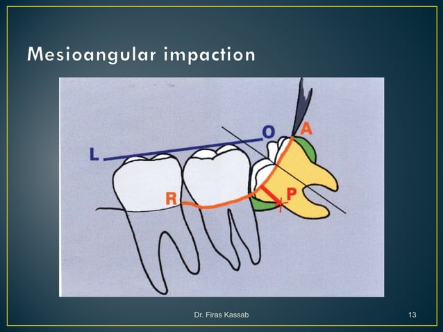 Surgical extraction of impacted teeth i | PDF