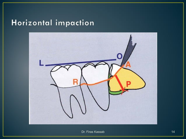 Surgical extraction of impacted teeth i | PDF