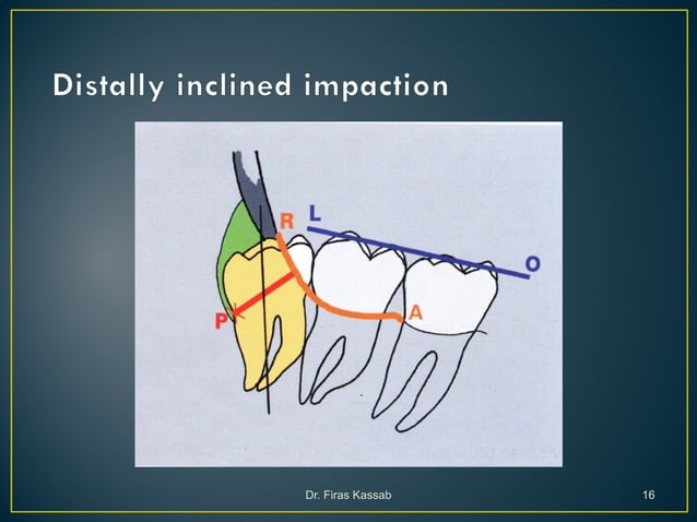 Surgical extraction of impacted teeth i | PDF
