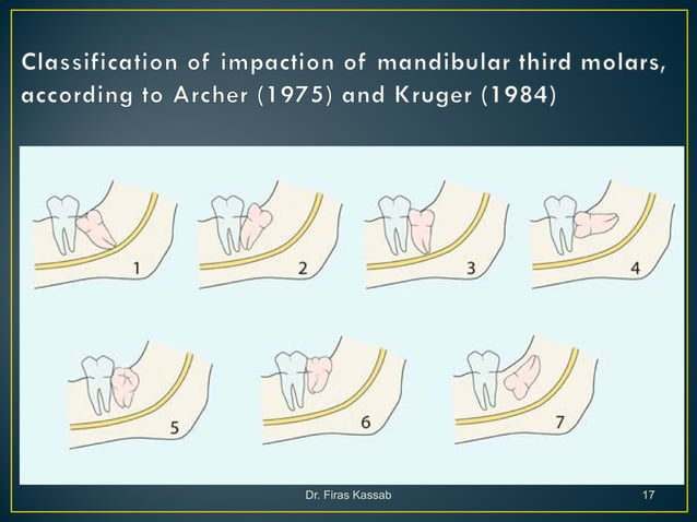 Surgical extraction of impacted teeth i | PDF