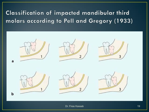 Surgical extraction of impacted teeth i | PDF