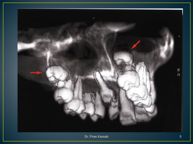 Surgical extraction of impacted teeth i | PDF