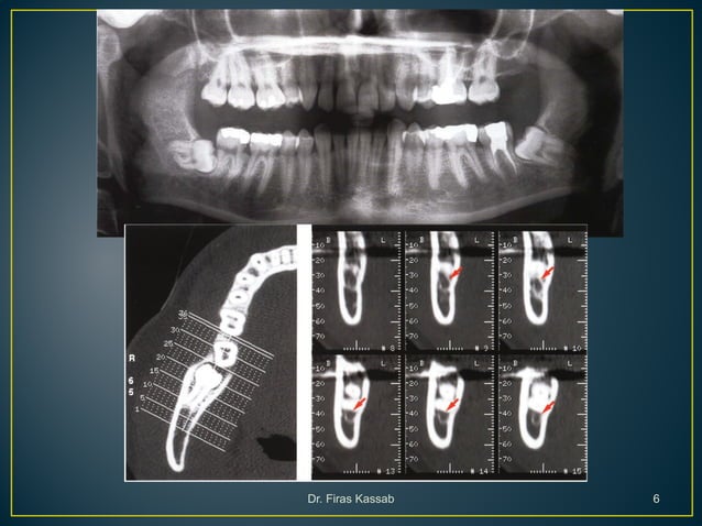 Surgical extraction of impacted teeth i | PDF