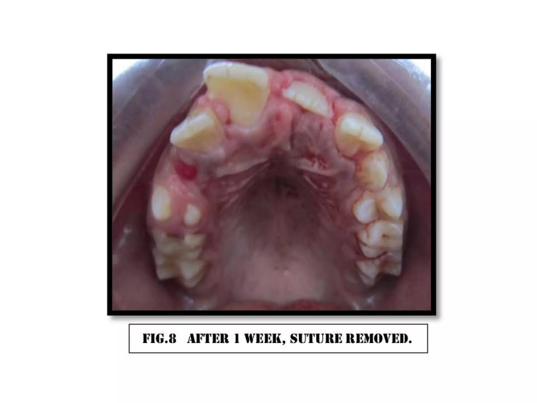 Surgical extraction of supernumerary tooth | PPTX