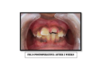 Surgical extraction of supernumerary tooth | PPTX