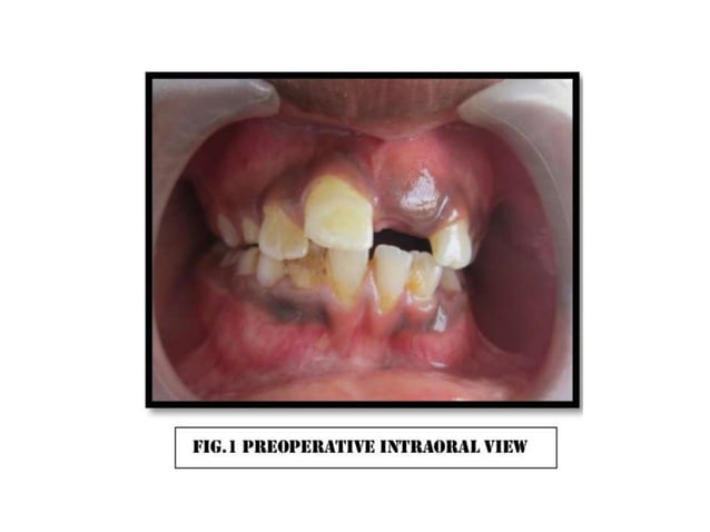 Surgical extraction of supernumerary tooth | PPTX | Dental Health ...