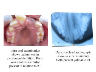 Surgical extraction of suprnumeraray tooth. | PPT