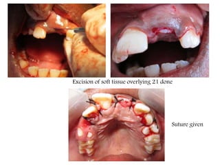 Surgical extraction of suprnumeraray tooth. | PPT