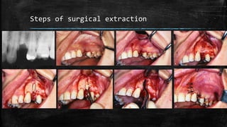 surgical extraction presentation.pdf
