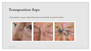 Surgical flaps in plastic surgery | PPTX