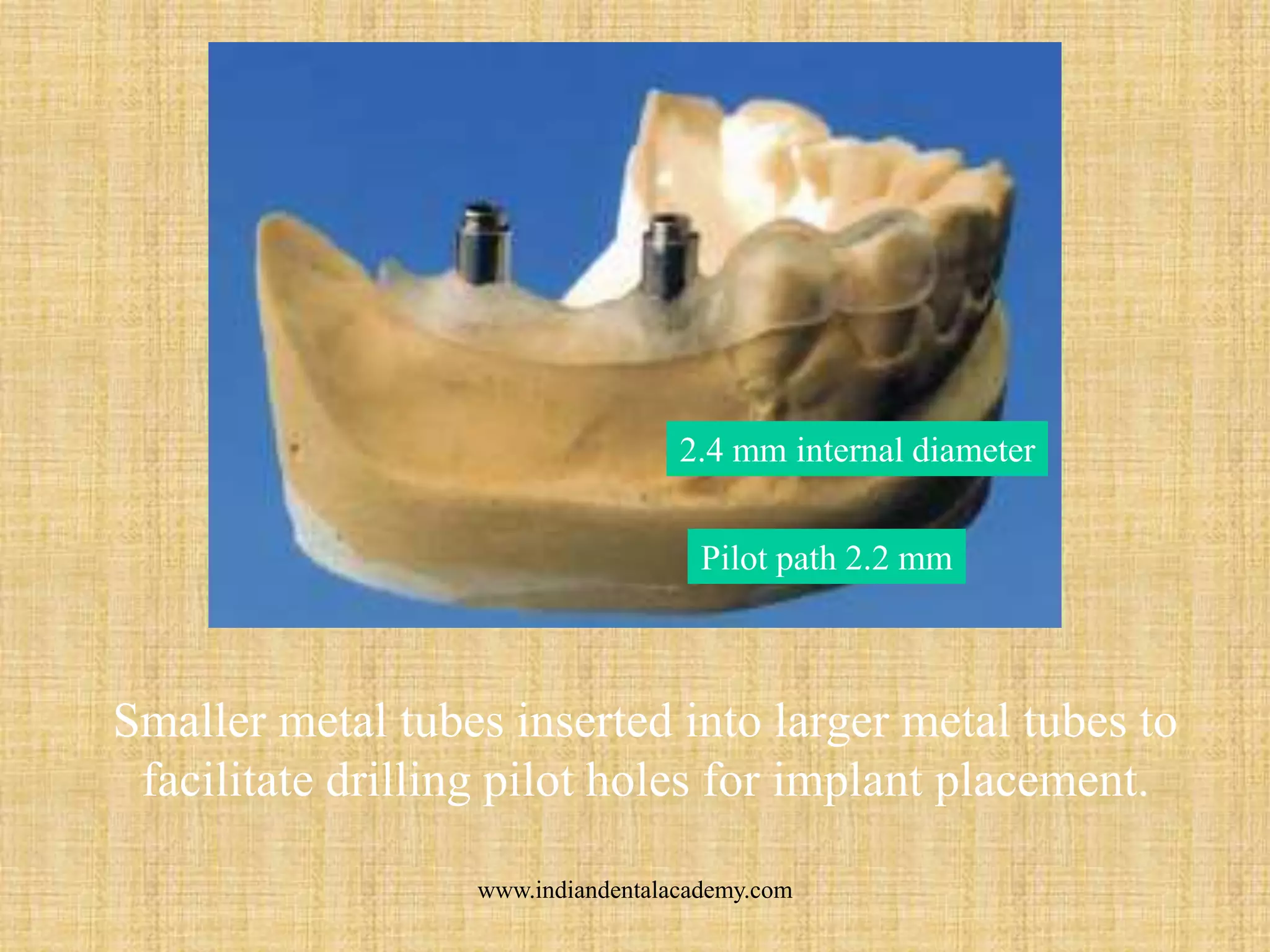 Surgical implant placement guides/ dentistry dental implants | PPT