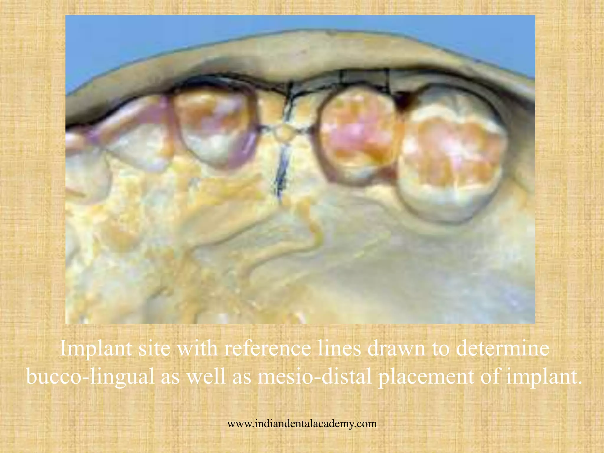 Surgical implant placement guides/ dentistry dental implants | PPT