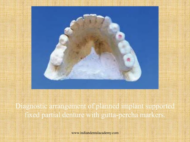 Surgical implant placement guides/ dentistry dental implants | PPT