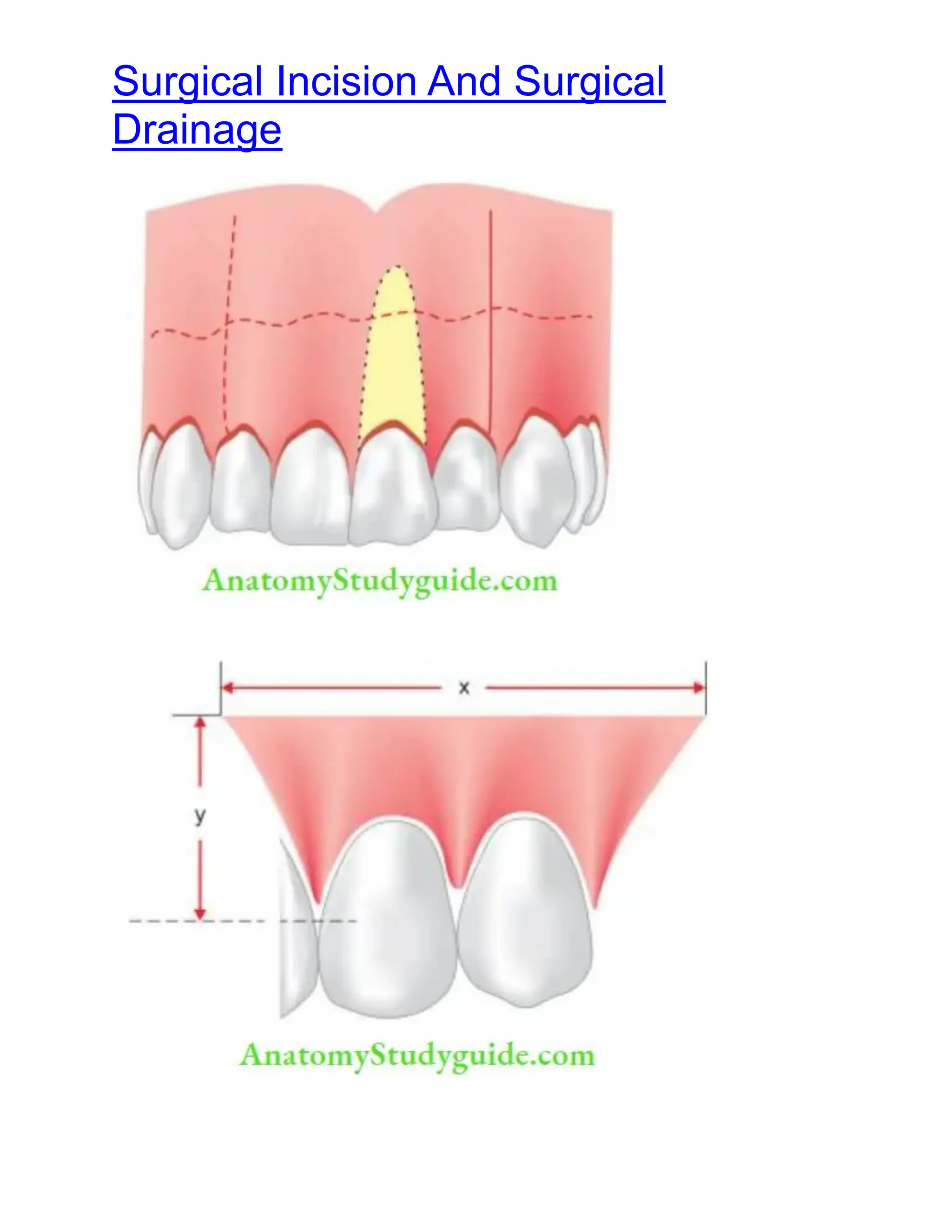 Surgical Incision And Drainage | PDF