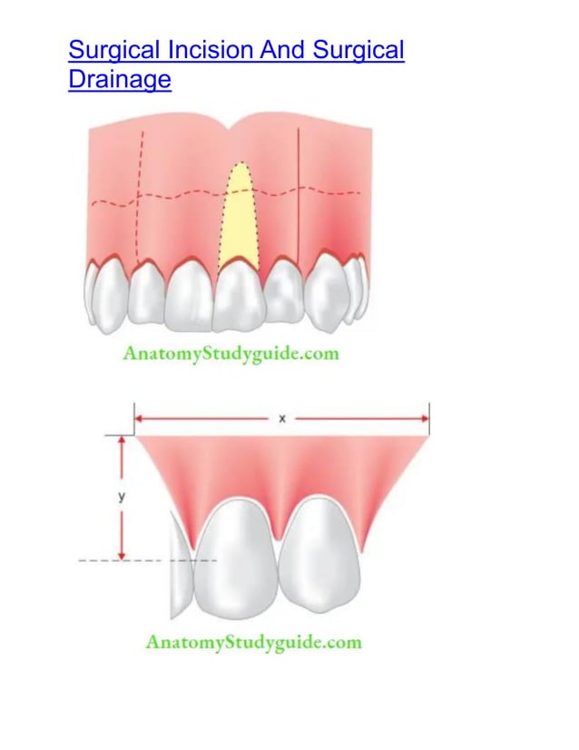 Surgical Incision And Drainage | PDF | Dental Health | Diseases and ...