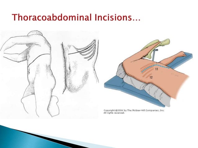 Surgicalincisions 150519180458-lva1-app6892 | PPT
