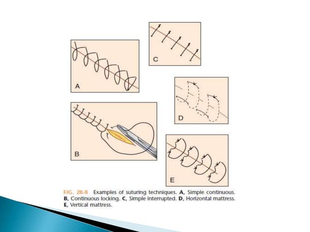 Surgicalincisions 150519180458-lva1-app6892 | PPT