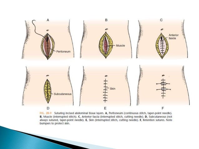 Surgicalincisions 150519180458-lva1-app6892 | PPT