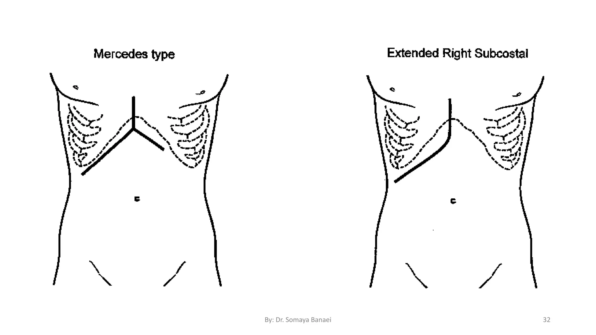 Surgical incisions | PDF