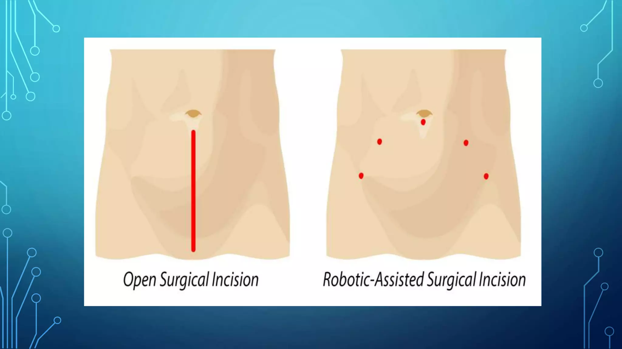 Surgical incisions | PPTX