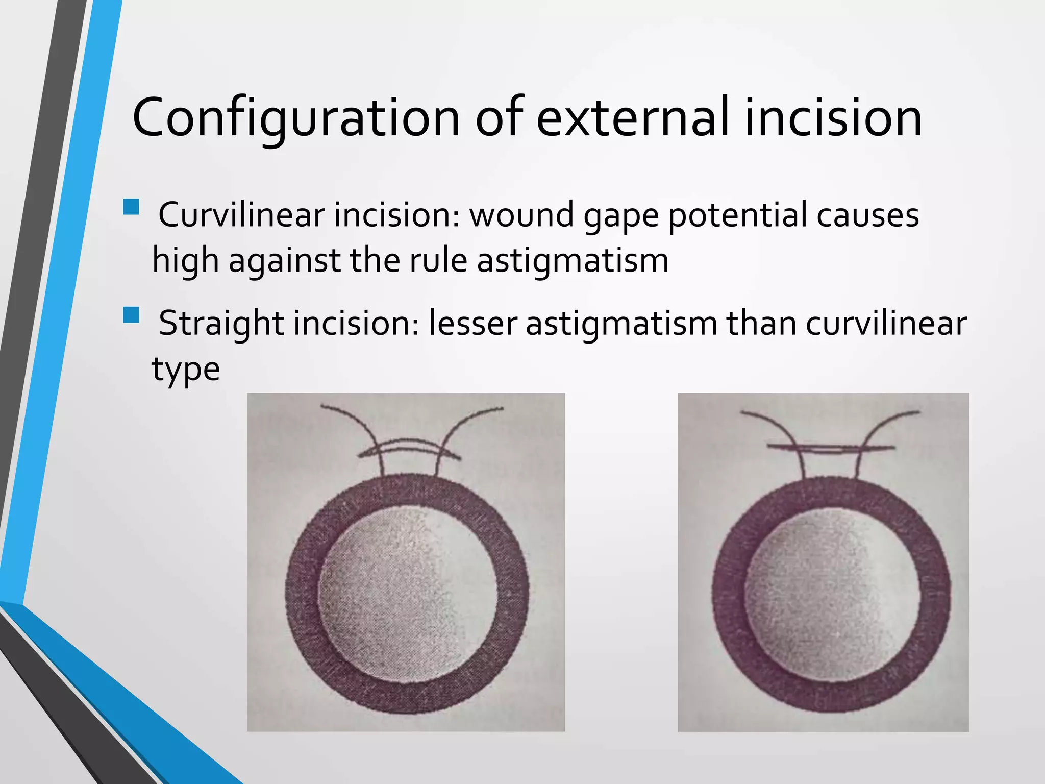 Surgical induced astigmatism | PPTX