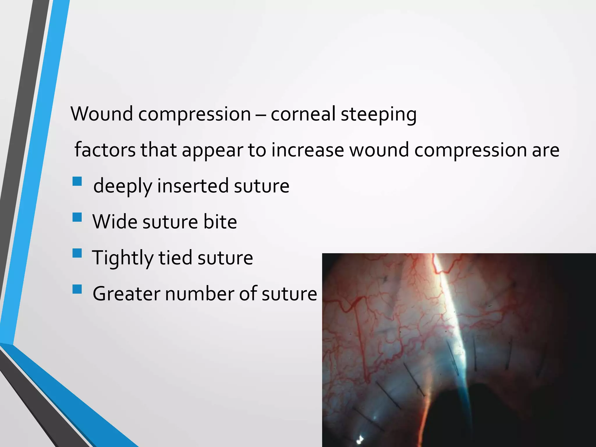 Surgical induced astigmatism | PPTX