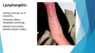 Surgical Infections ppt. with tables and detail | PPTX