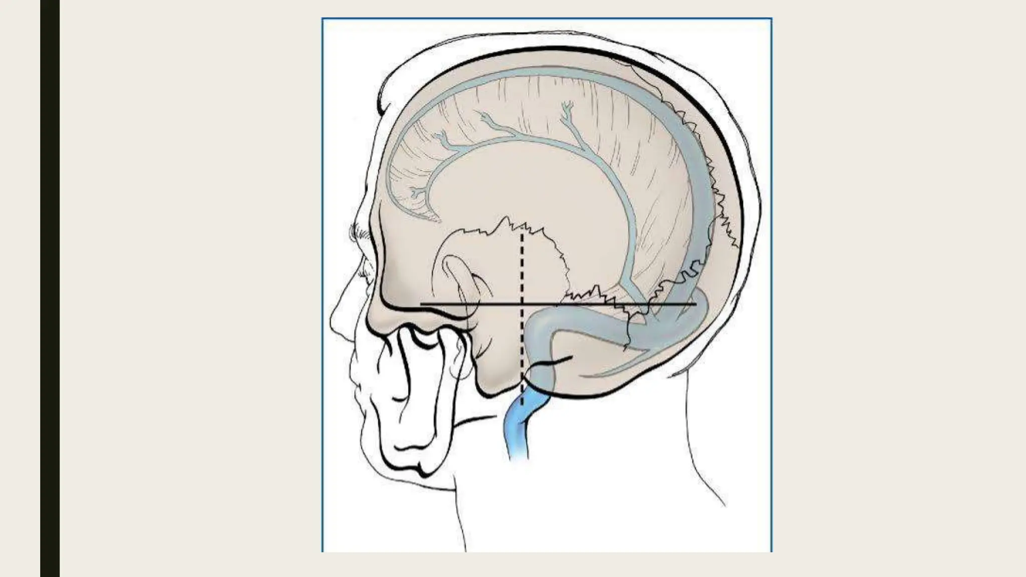 Surgical landmarks of Brain and its identification on Cranium | PPT