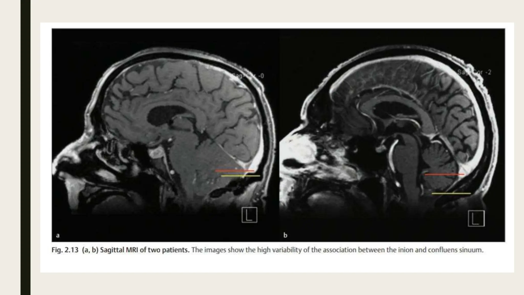 Surgical landmarks of Brain and its identification on Cranium | PPT