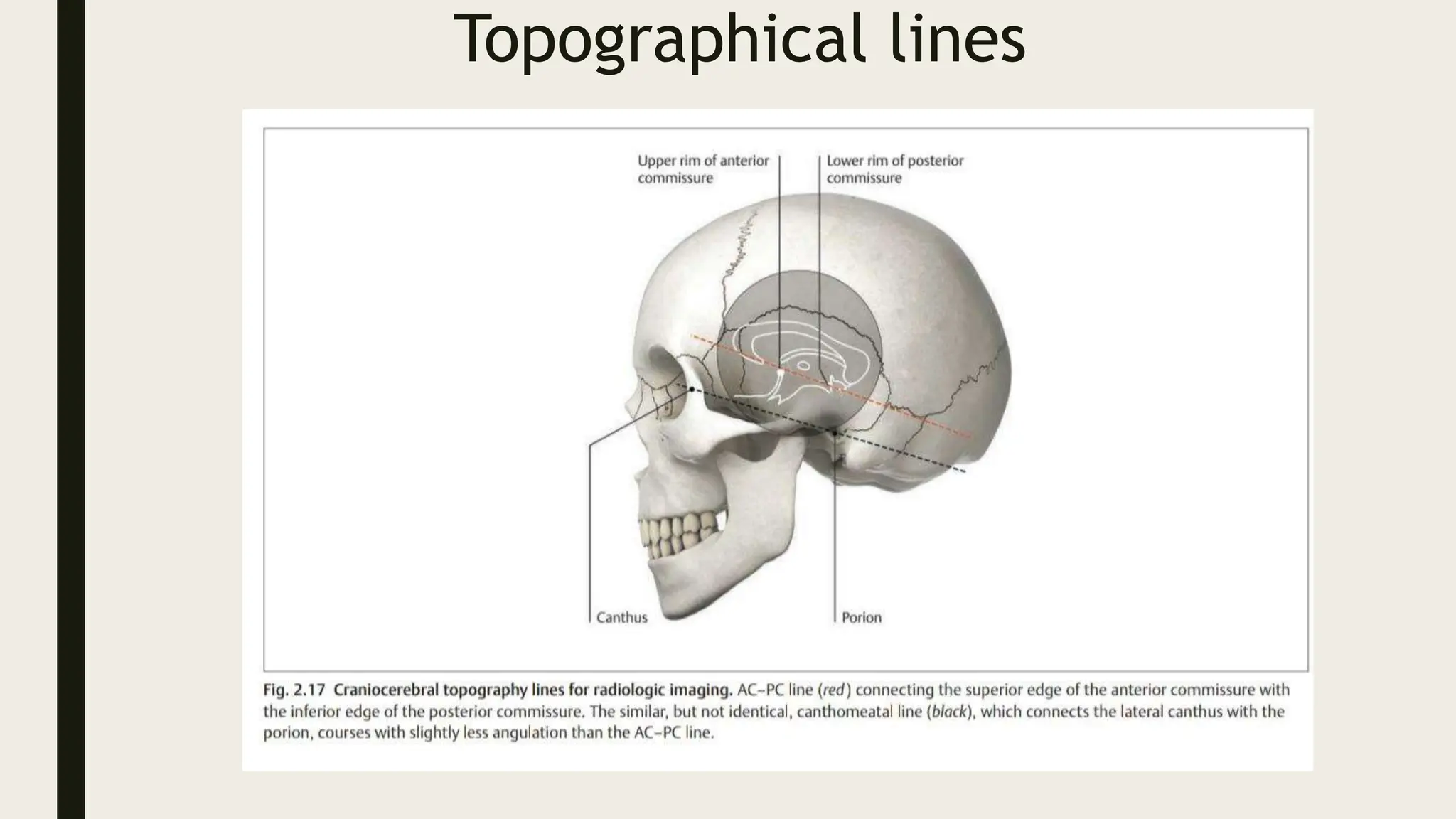 Surgical landmarks of Brain and its identification on Cranium | PPT