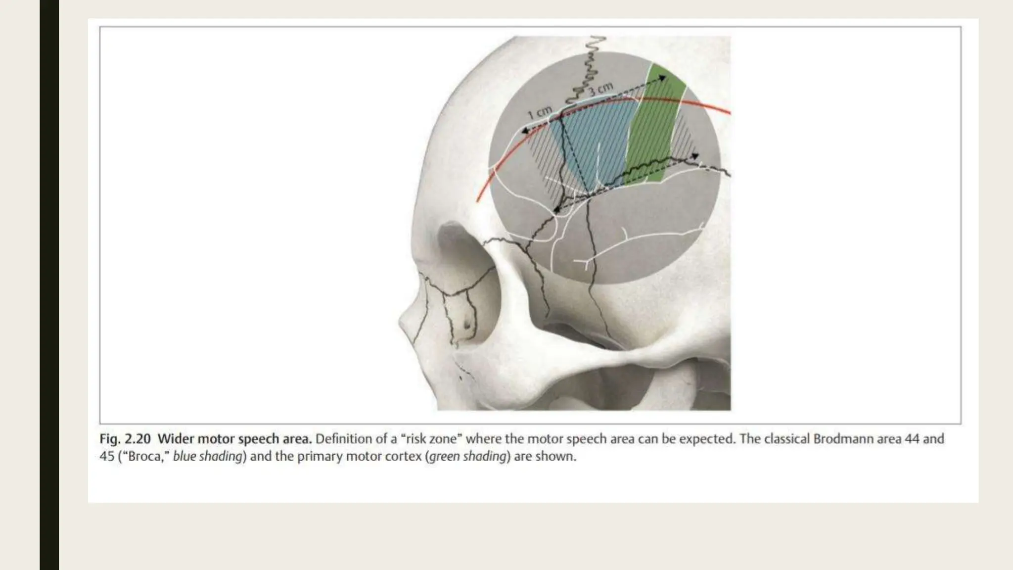 Surgical landmarks of Brain and its identification on Cranium | PPT
