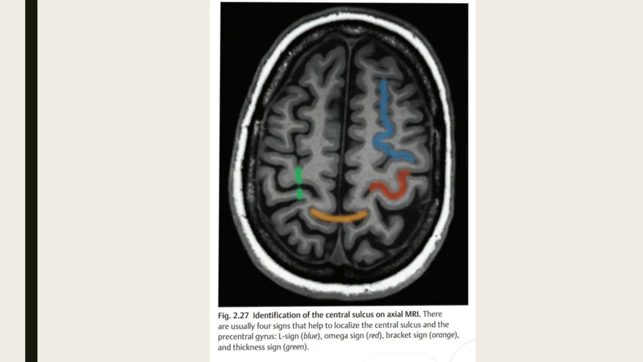 Surgical landmarks of Brain and its identification on Cranium | PPT