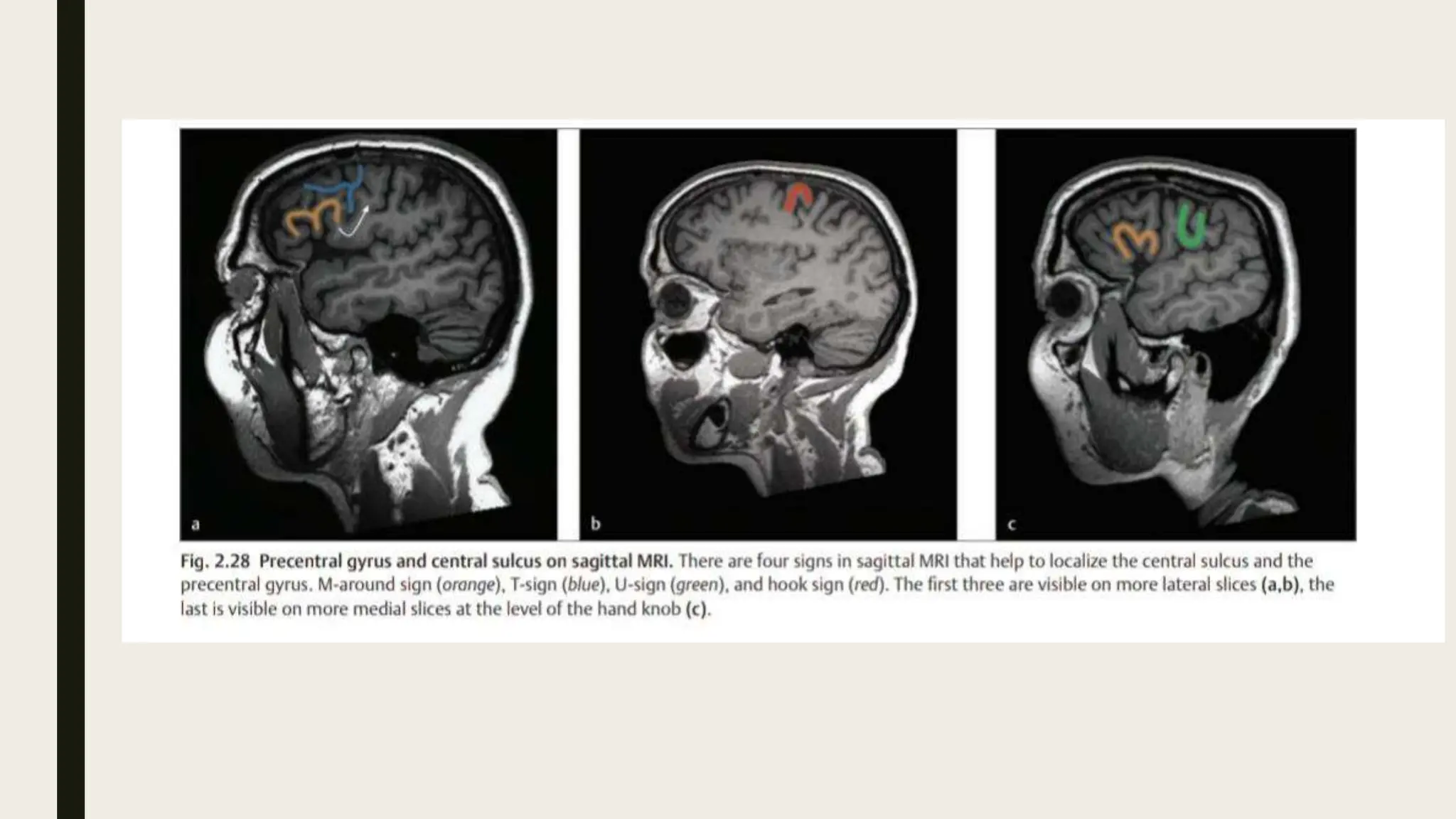 Surgical landmarks of Brain and its identification on Cranium | PPT