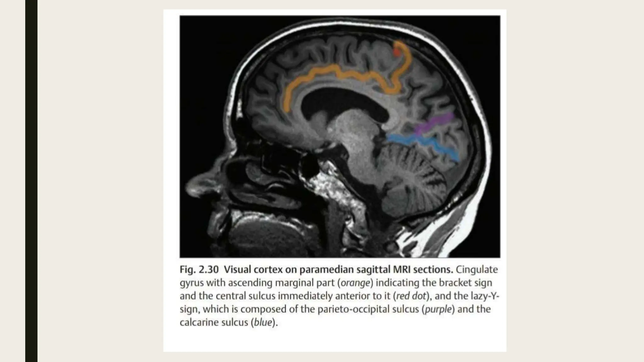 Surgical landmarks of Brain and its identification on Cranium | PPT