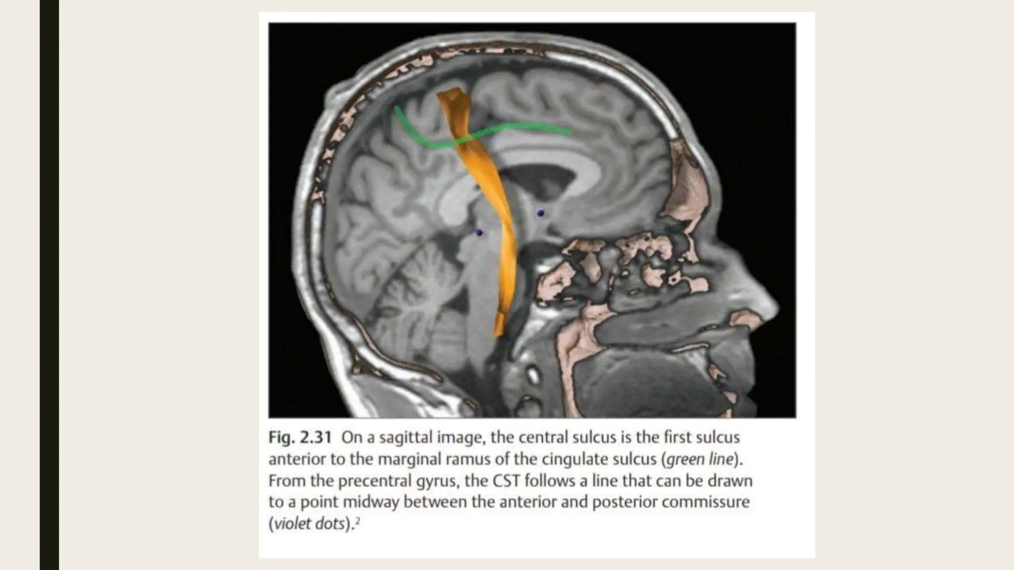 Surgical landmarks of Brain and its identification on Cranium | PPT