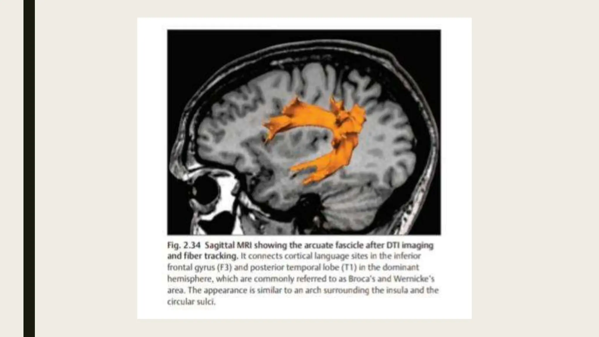 Surgical landmarks of Brain and its identification on Cranium | PPT