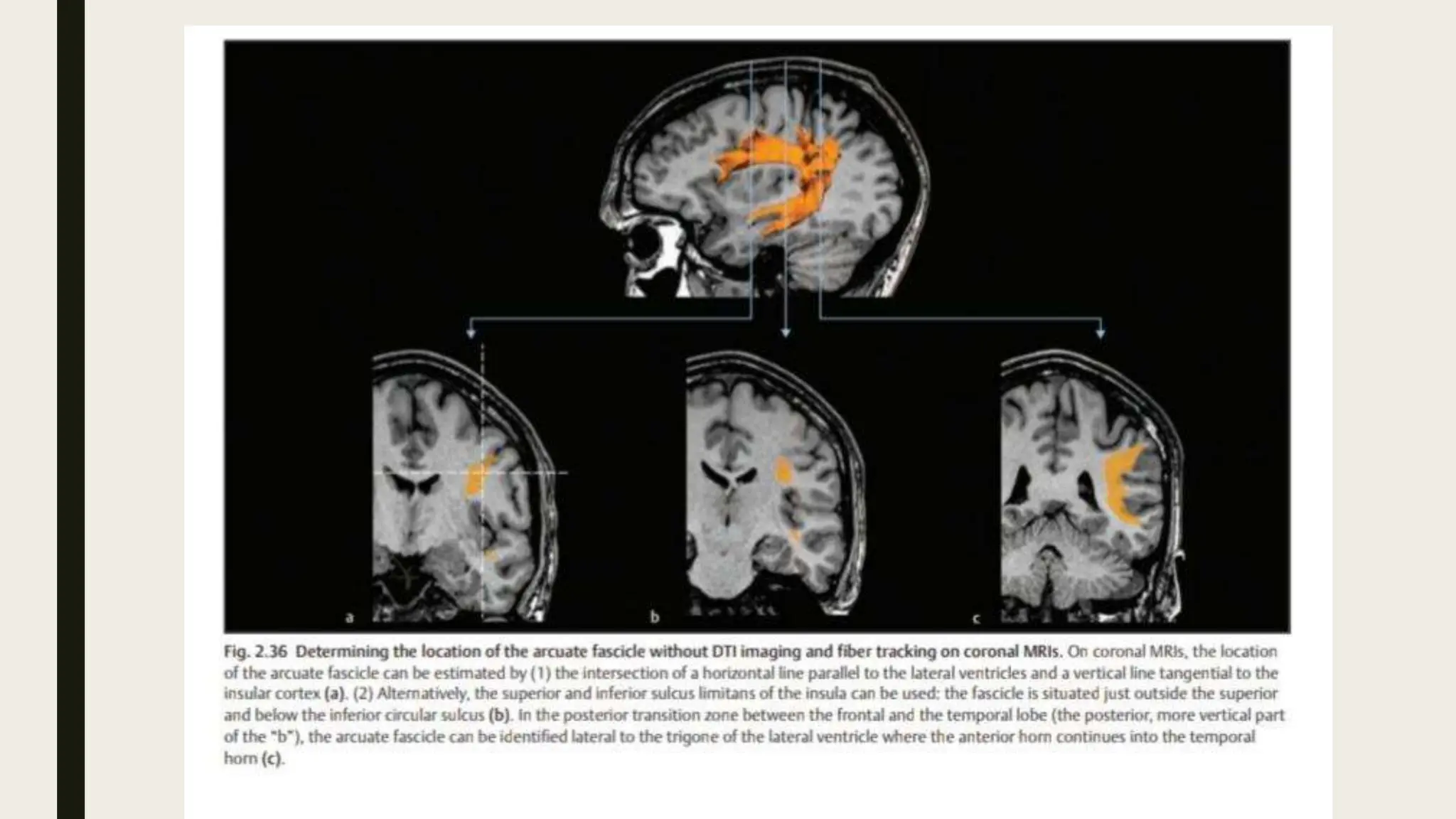 Surgical landmarks of Brain and its identification on Cranium | PPT