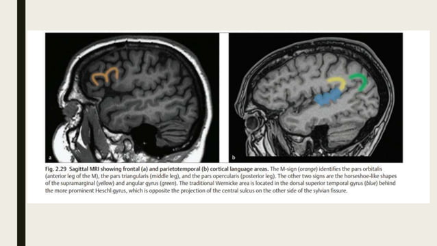 Surgical landmarks of Brain and its identification on Cranium | PPT