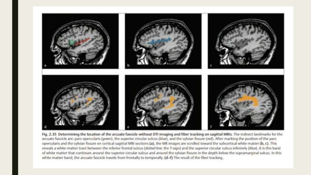 Surgical landmarks of Brain and its identification on Cranium | PPT
