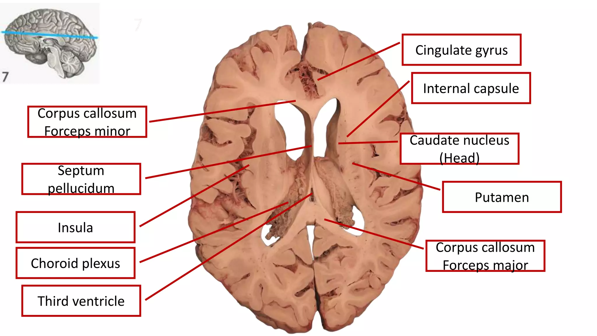 Surgical landmarks and sectional anatomy in neurosurgery | PPTX