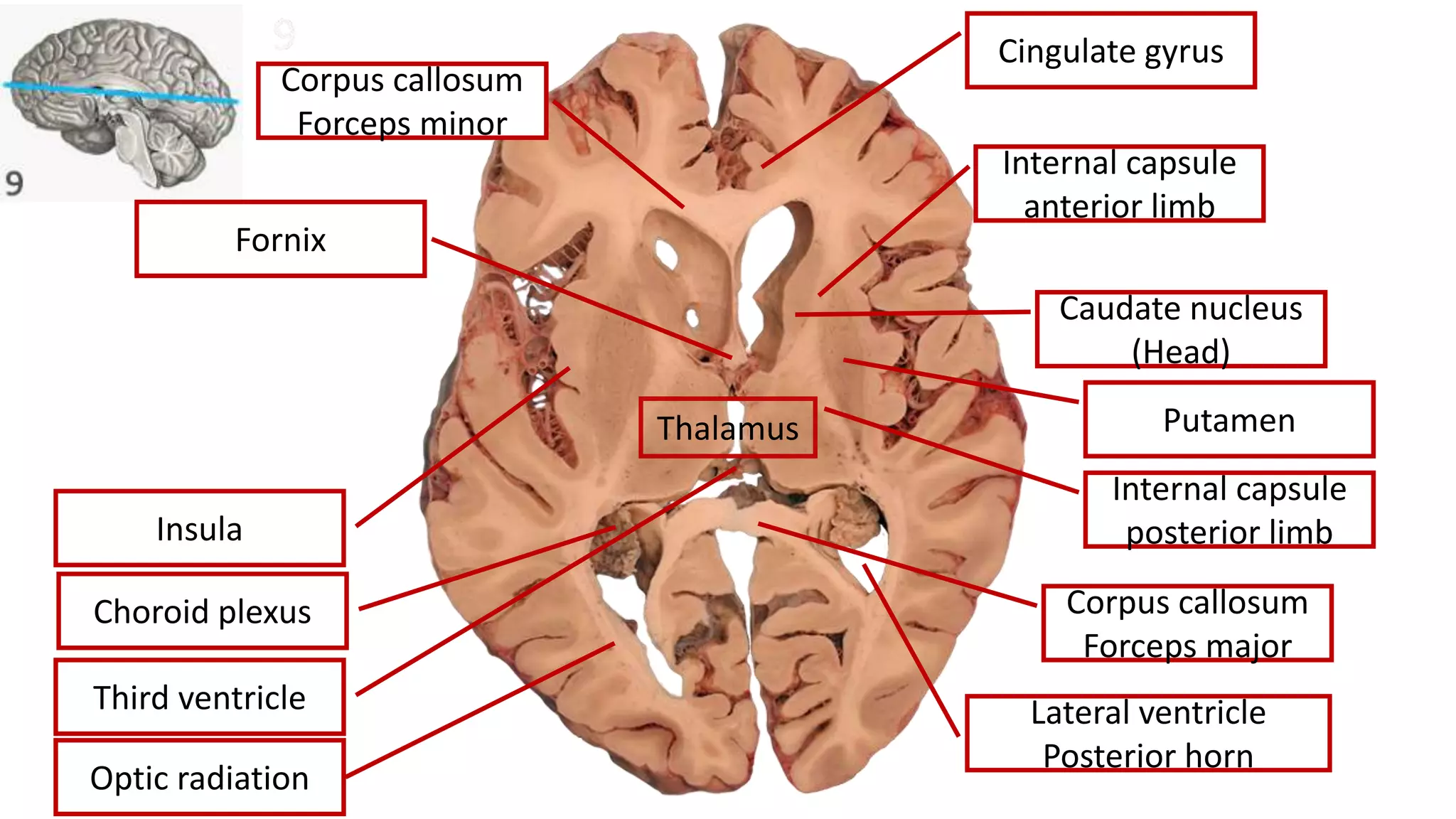 Surgical landmarks and sectional anatomy in neurosurgery | PPTX