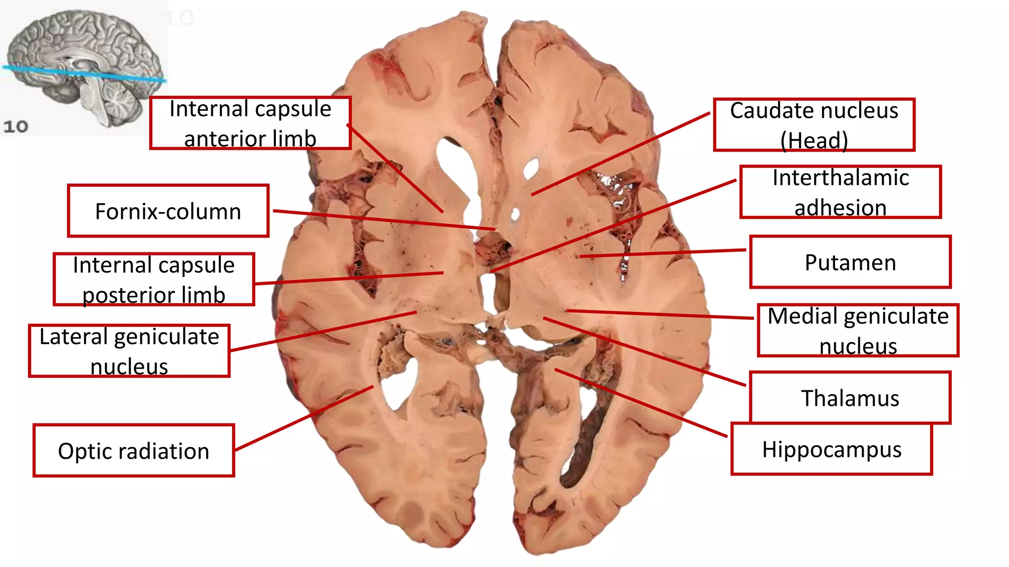 Surgical landmarks and sectional anatomy in neurosurgery | PPTX