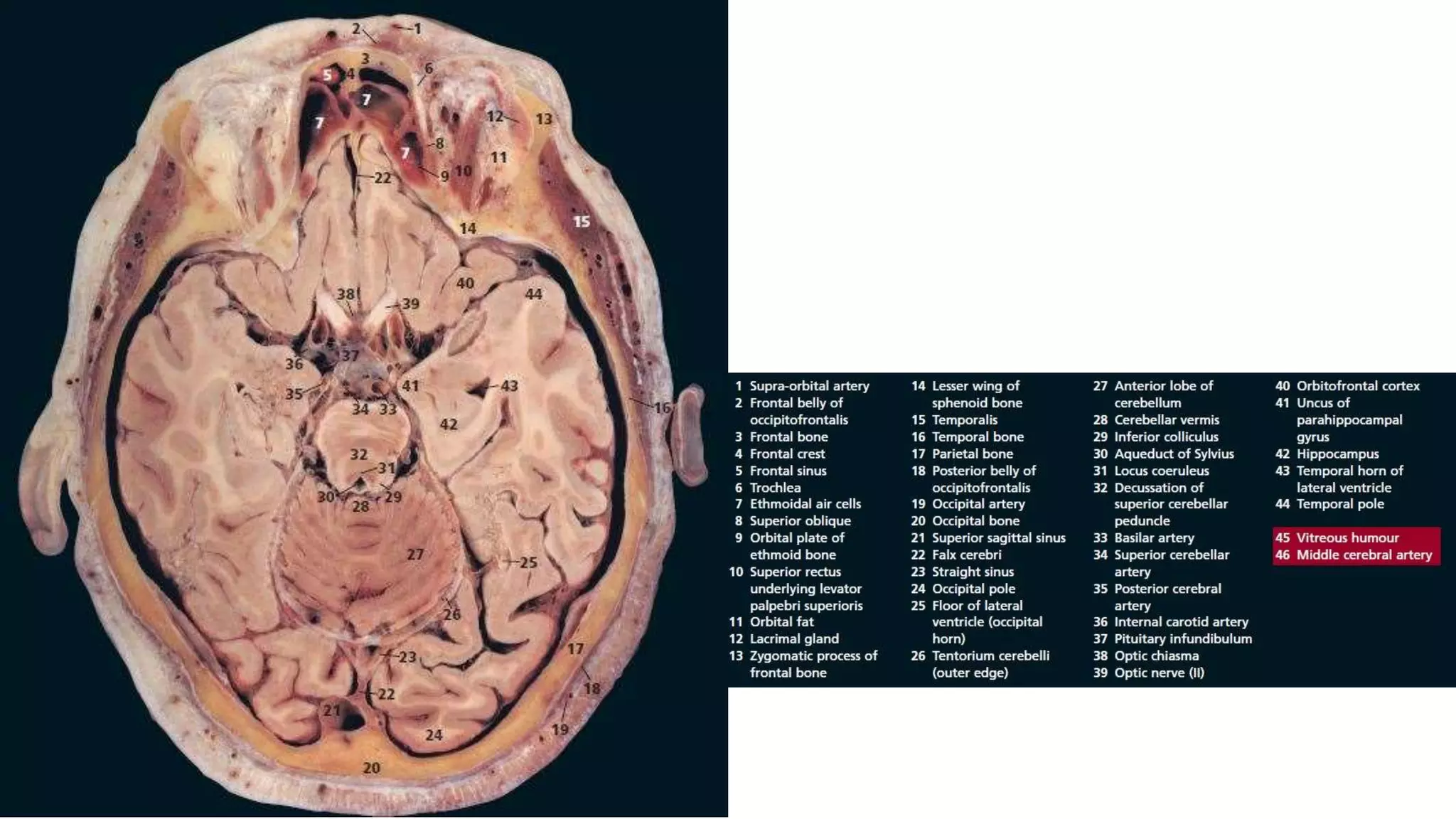 Surgical landmarks and sectional anatomy in neurosurgery | PPTX