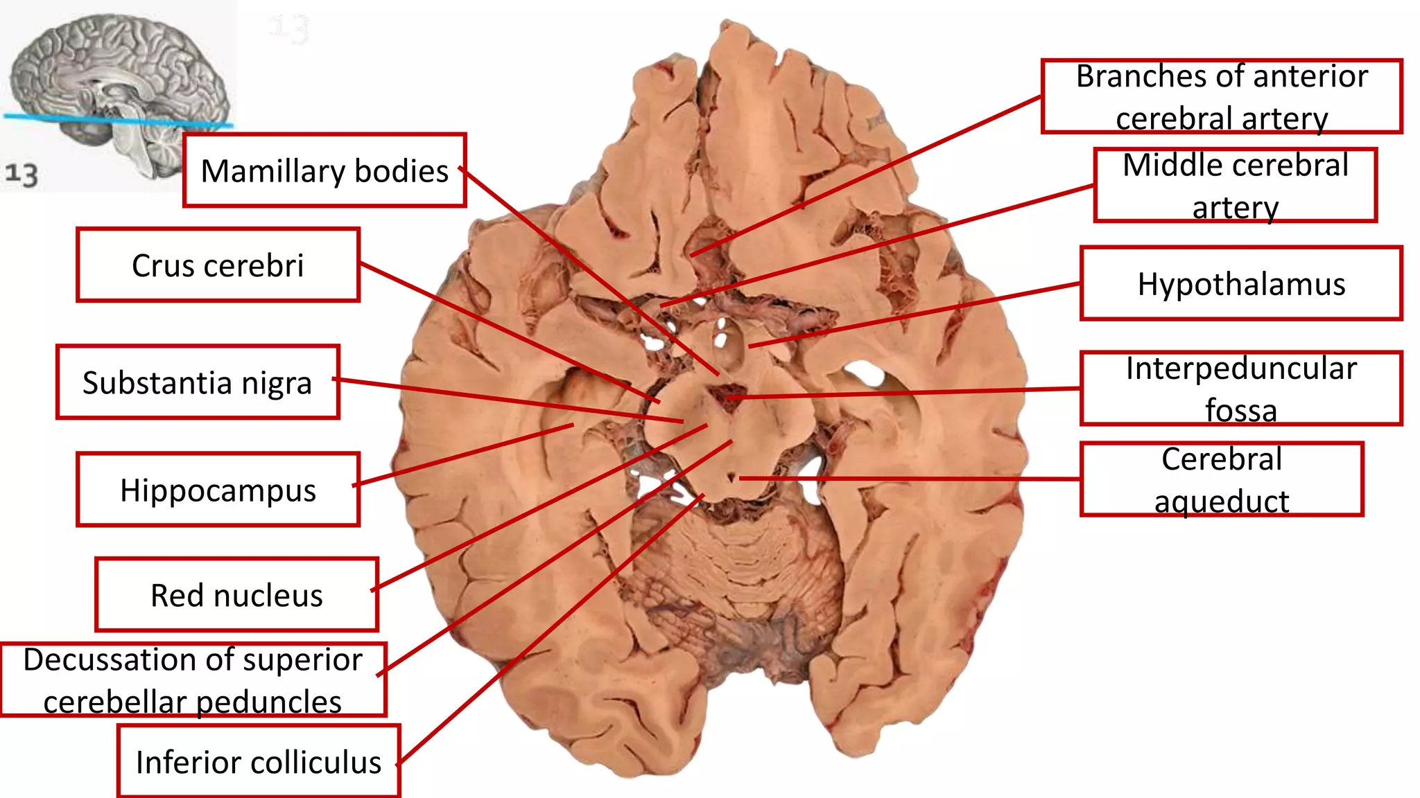 Surgical landmarks and sectional anatomy in neurosurgery | PPTX